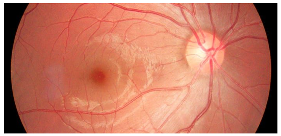 Toxoplasmose Ocular - Oftalmologista em Natal RN Pedro Paulo Cabral