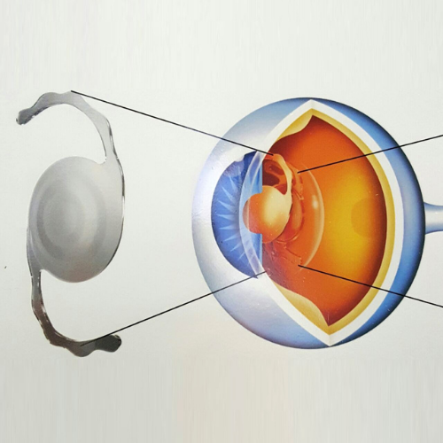 Cirurgia de Catarata com Lentes Monofocais para longe - Oftalmologista ...